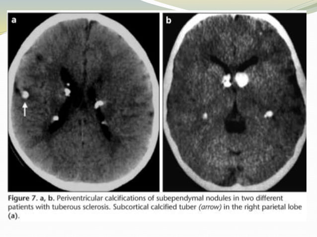 Physiological And Pathological Calcification Of Brain Ppt