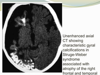 PHYSIOLOGICAL AND PATHOLOGICAL CALCIFICATION OF BRAIN | PPTX