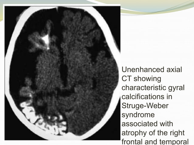 PHYSIOLOGICAL AND PATHOLOGICAL CALCIFICATION OF BRAIN | PPTX