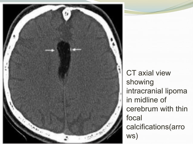 PHYSIOLOGICAL AND PATHOLOGICAL CALCIFICATION OF BRAIN | PPTX