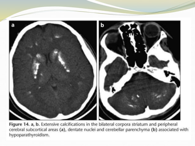PHYSIOLOGICAL AND PATHOLOGICAL CALCIFICATION OF BRAIN | PPTX