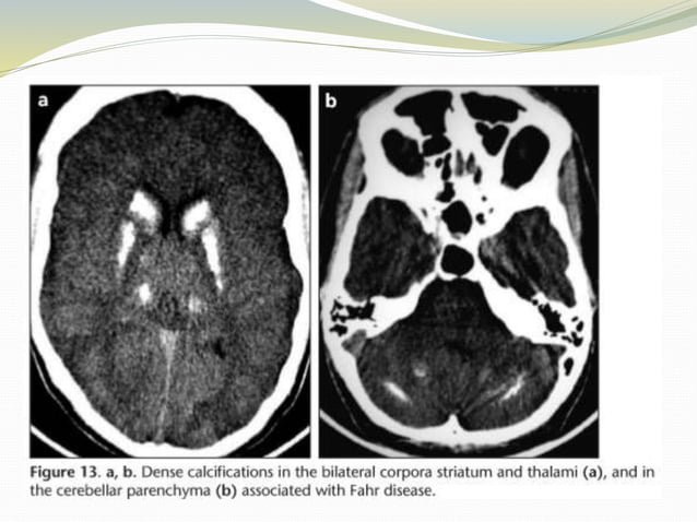 PHYSIOLOGICAL AND PATHOLOGICAL CALCIFICATION OF BRAIN | PPTX