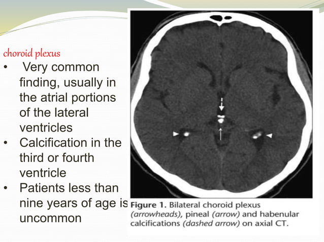 PHYSIOLOGICAL AND PATHOLOGICAL CALCIFICATION OF BRAIN | PPTX