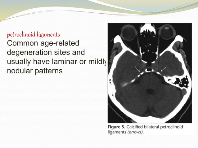 PHYSIOLOGICAL AND PATHOLOGICAL CALCIFICATION OF BRAIN | PPTX