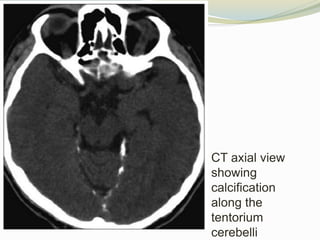 PHYSIOLOGICAL AND PATHOLOGICAL CALCIFICATION OF BRAIN | PPT