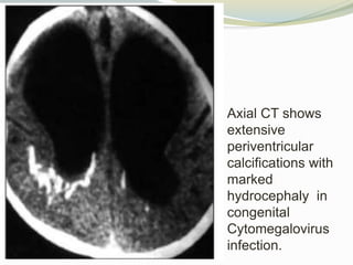 Cmv Periventricular Calcification
