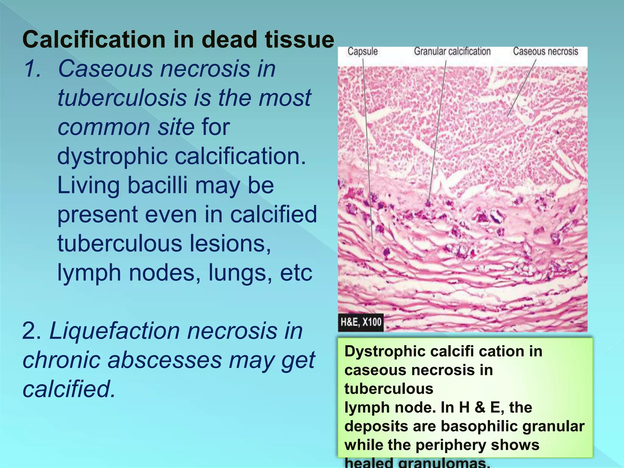 Calcification.pptx