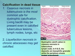 Calcification.pptx