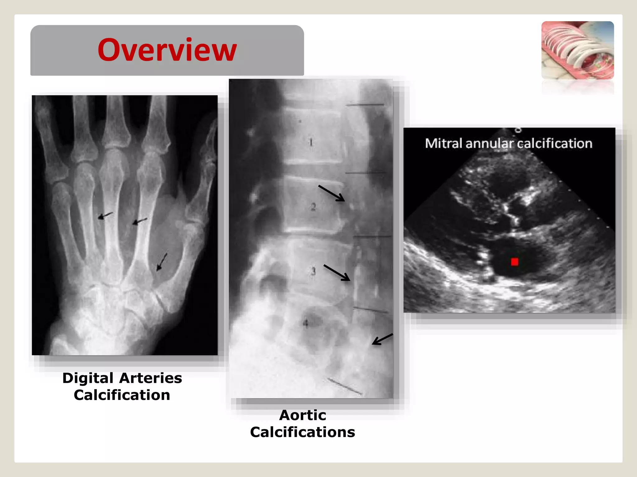 Calcification inhibitors in ckd and dialysis patients | PPTX