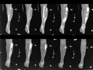 Calcific Myo-necrosis | PPTX