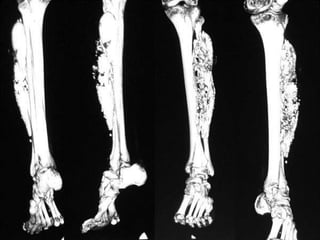 Calcific Myo-necrosis | PPTX