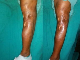 Calcific Myo-necrosis | PPTX
