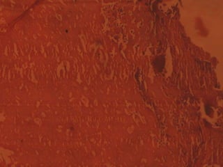 Calcific Myo-necrosis | PPTX