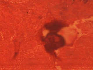Calcific Myo-necrosis | PPTX
