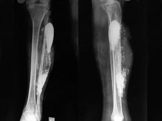 Calcific Myo-necrosis | PPTX