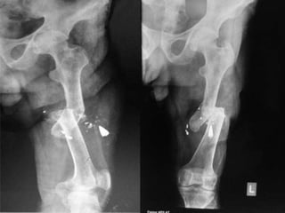 Calcific Myo-necrosis | PPTX