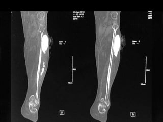 Calcific Myo-necrosis | PPTX