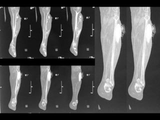 Calcific Myo-necrosis | PPTX