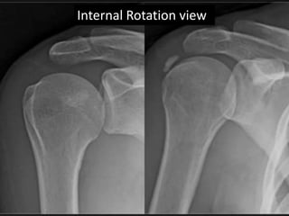 Calcific tendinitis of shoulder | PPT