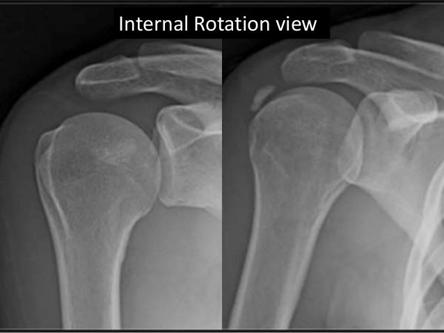 Calcific tendinitis of shoulder