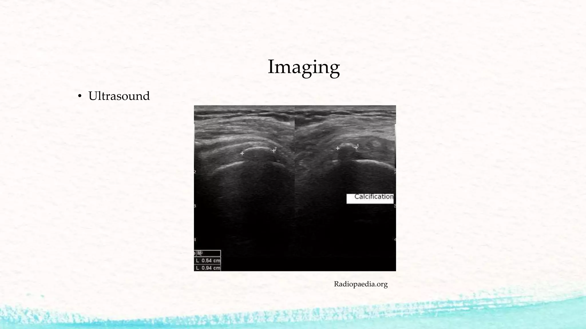 Calcific Tendinitis of the Rotator Cuff | PPTX