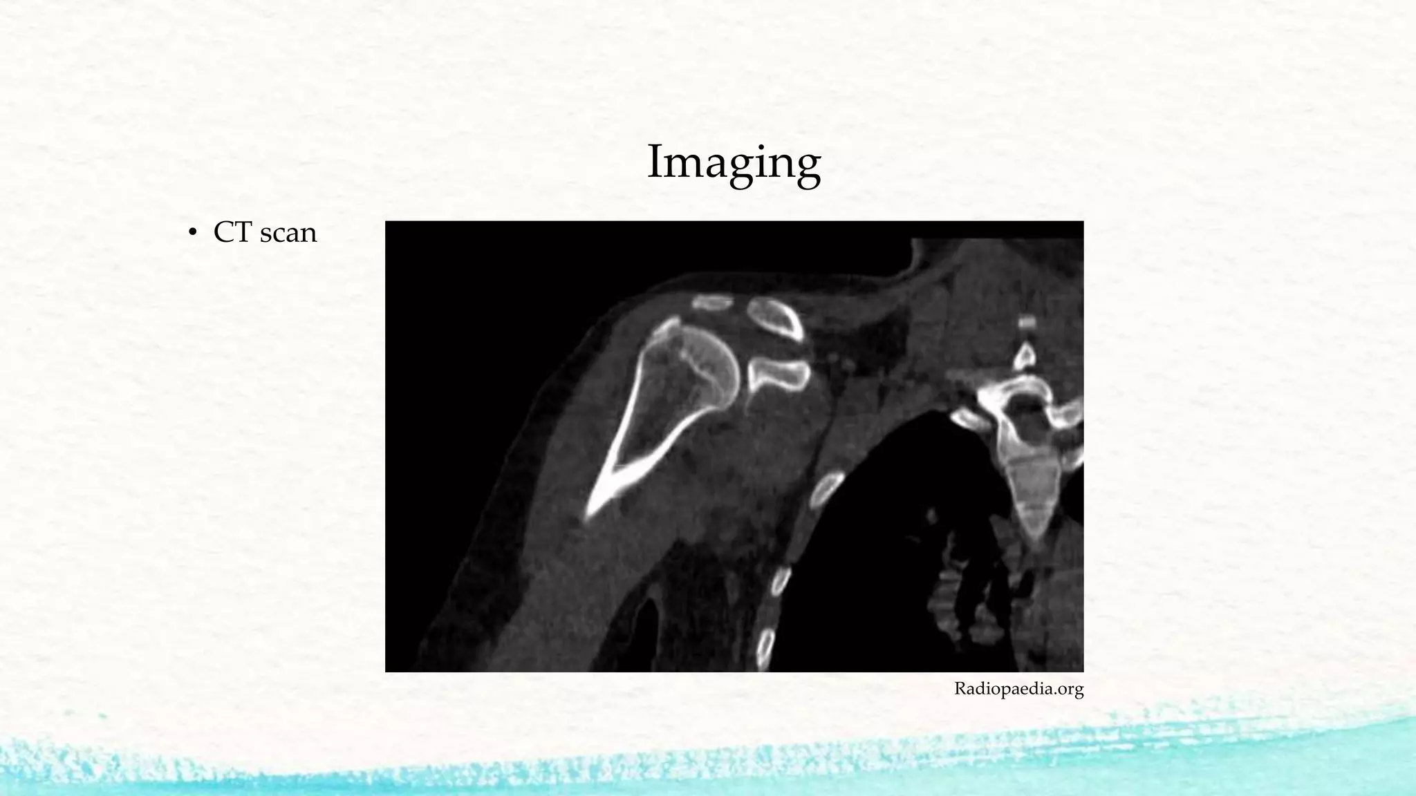 Calcific Tendinitis of the Rotator Cuff | PPTX