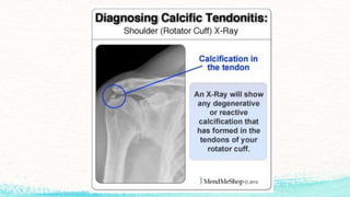 Calcific Tendinitis of the Rotator Cuff | PPTX
