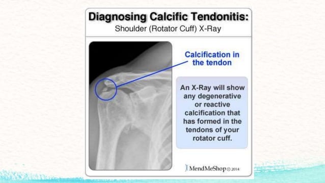 Calcific Tendinitis of the Rotator Cuff | PPTX