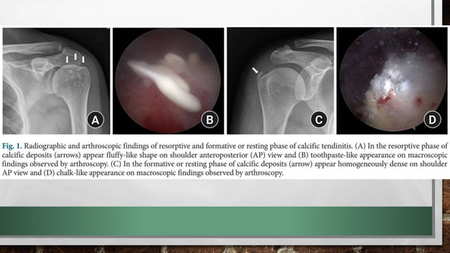 Calcified Tenditinitis of The Shoulder.pptx