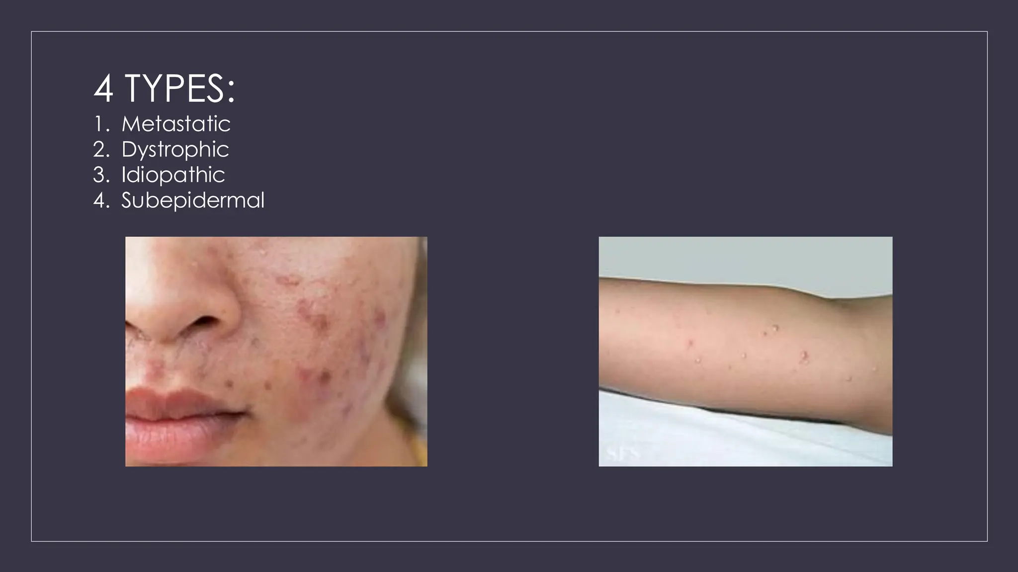 Calcinosis Cutis - A Medical Condition.. | PPT