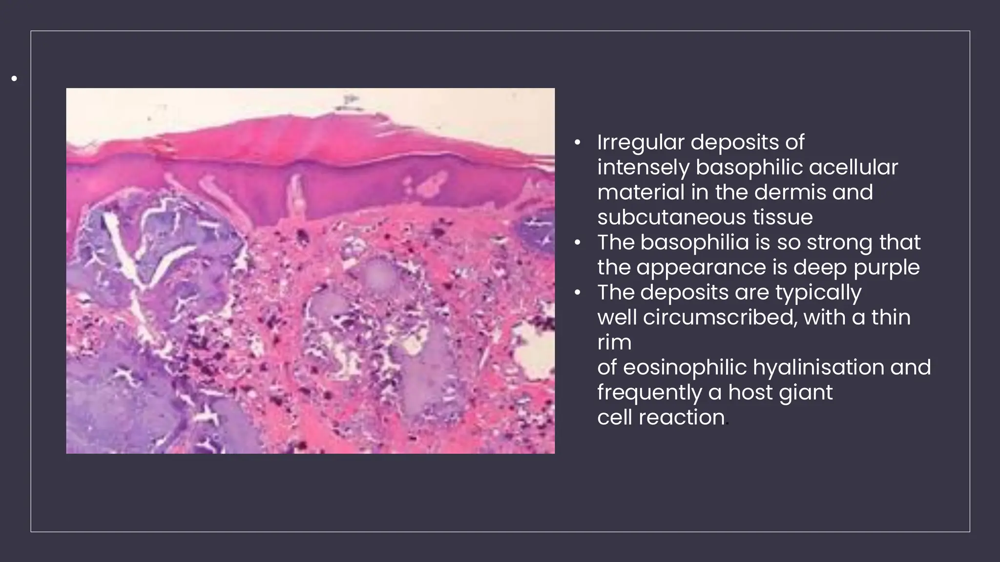 Calcinosis Cutis - A Medical Condition.. | PPT