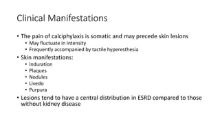 Calciphylaxis | PPTX
