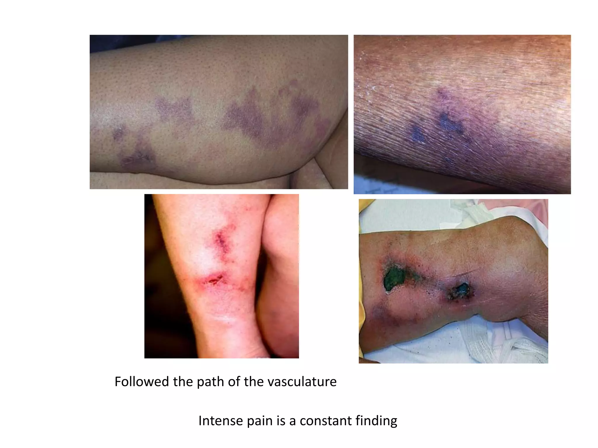 Calciphylaxis | PPTX