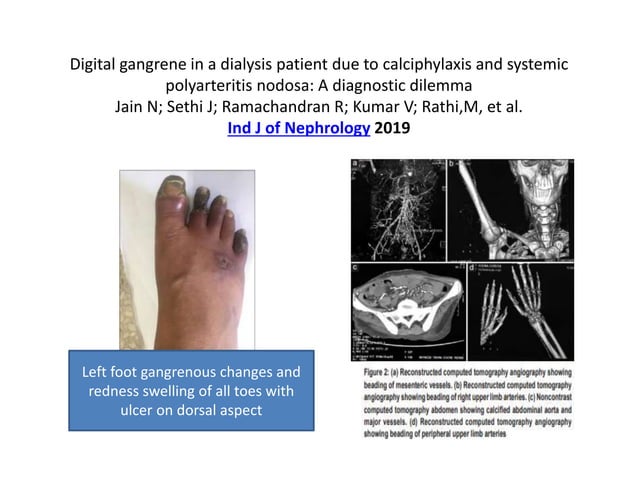 Calciphylaxis | PPTX