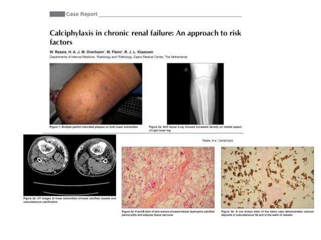 Calciphylaxis | PPTX