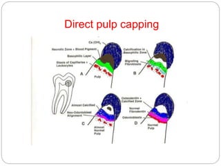 Calcium hydroxide | PPTX | Dental Health | Diseases and Conditions