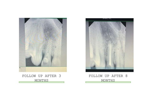 CALCIUM HYDROXIDE EXTRUSION..........pptx