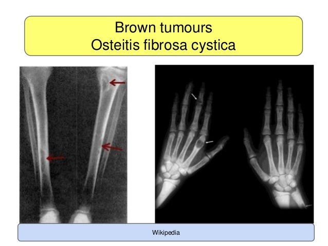 Osteitis Fibrosa Cystica X Ray