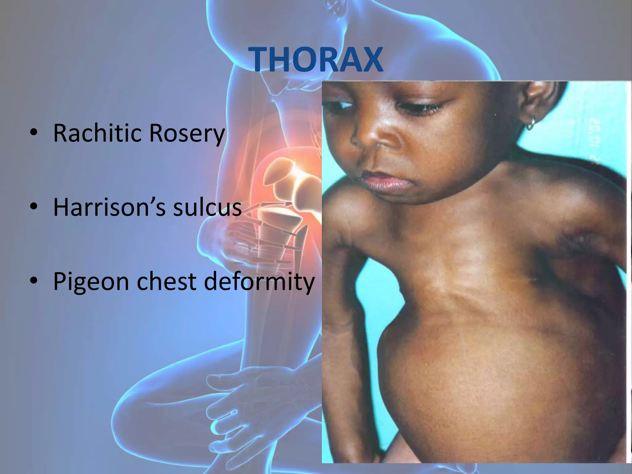 Calcium metabolism, rickets and osteomalacia | PPTX