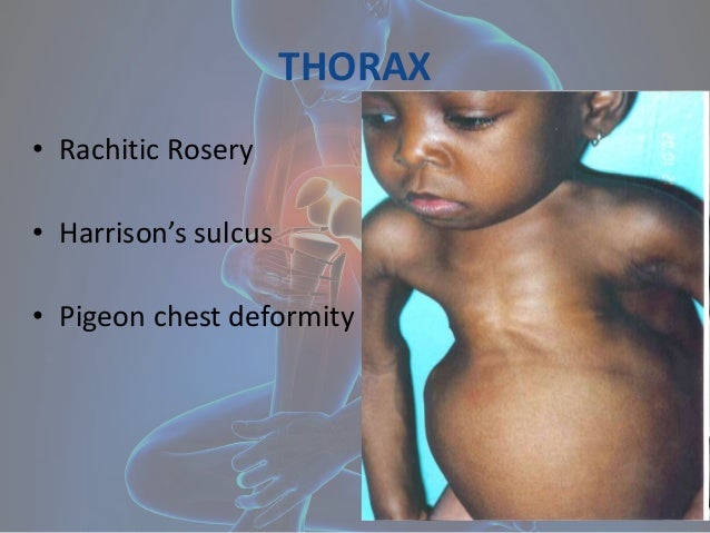 Calcium metabolism, rickets and osteomalacia