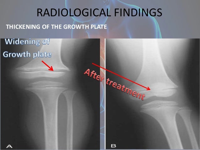 Calcium metabolism, rickets and osteomalacia