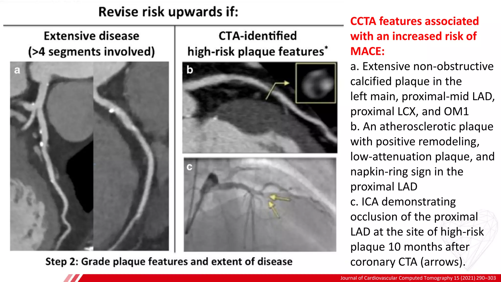 CALCIUM MODIFICATION TECHNIQUES IN COMPLEX PCI | PDF | Heart and ...