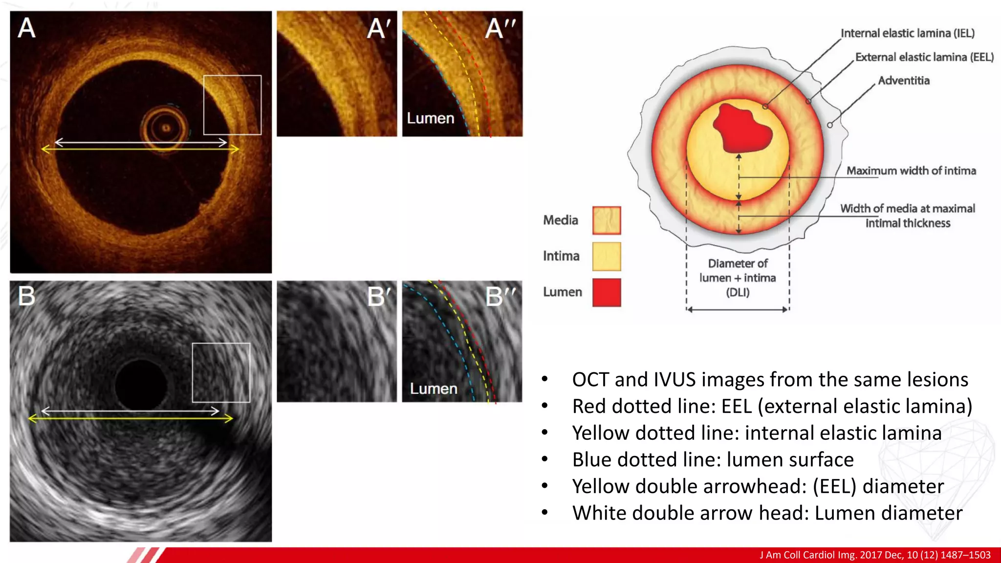 CALCIUM MODIFICATION TECHNIQUES IN COMPLEX PCI | PDF