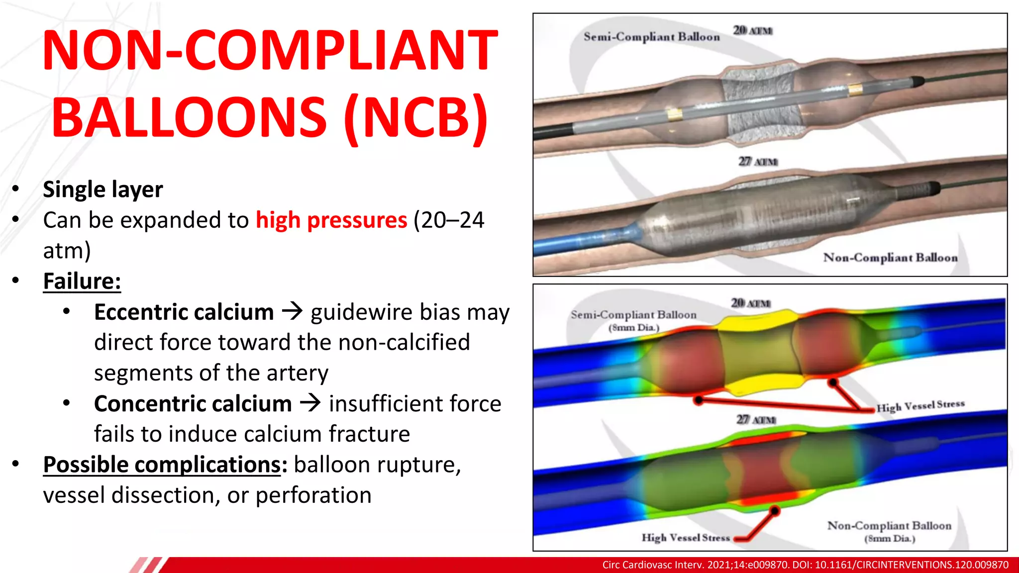 CALCIUM MODIFICATION TECHNIQUES IN COMPLEX PCI | PDF | Heart and ...