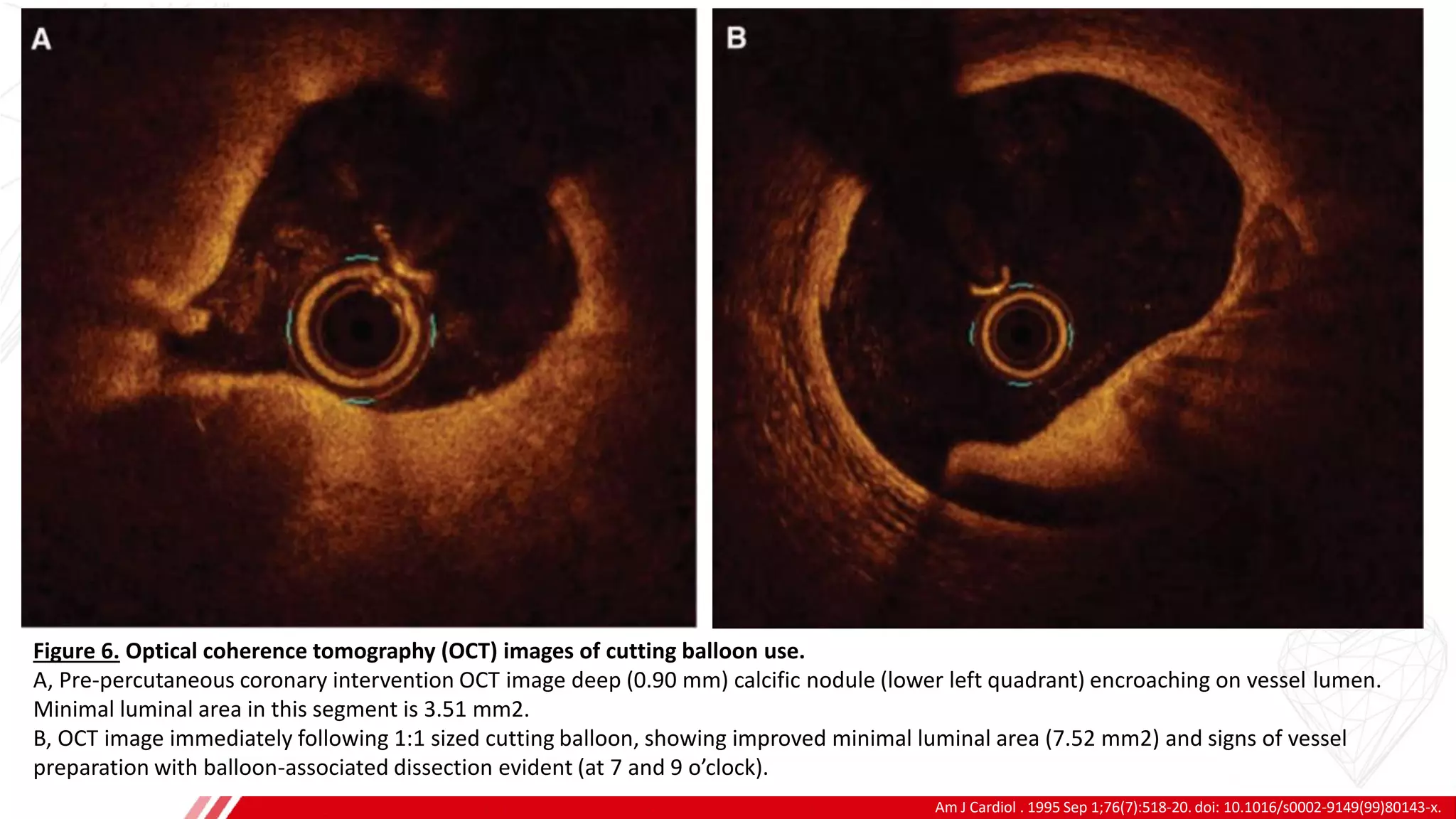 CALCIUM MODIFICATION TECHNIQUES IN COMPLEX PCI | PDF | Heart and ...
