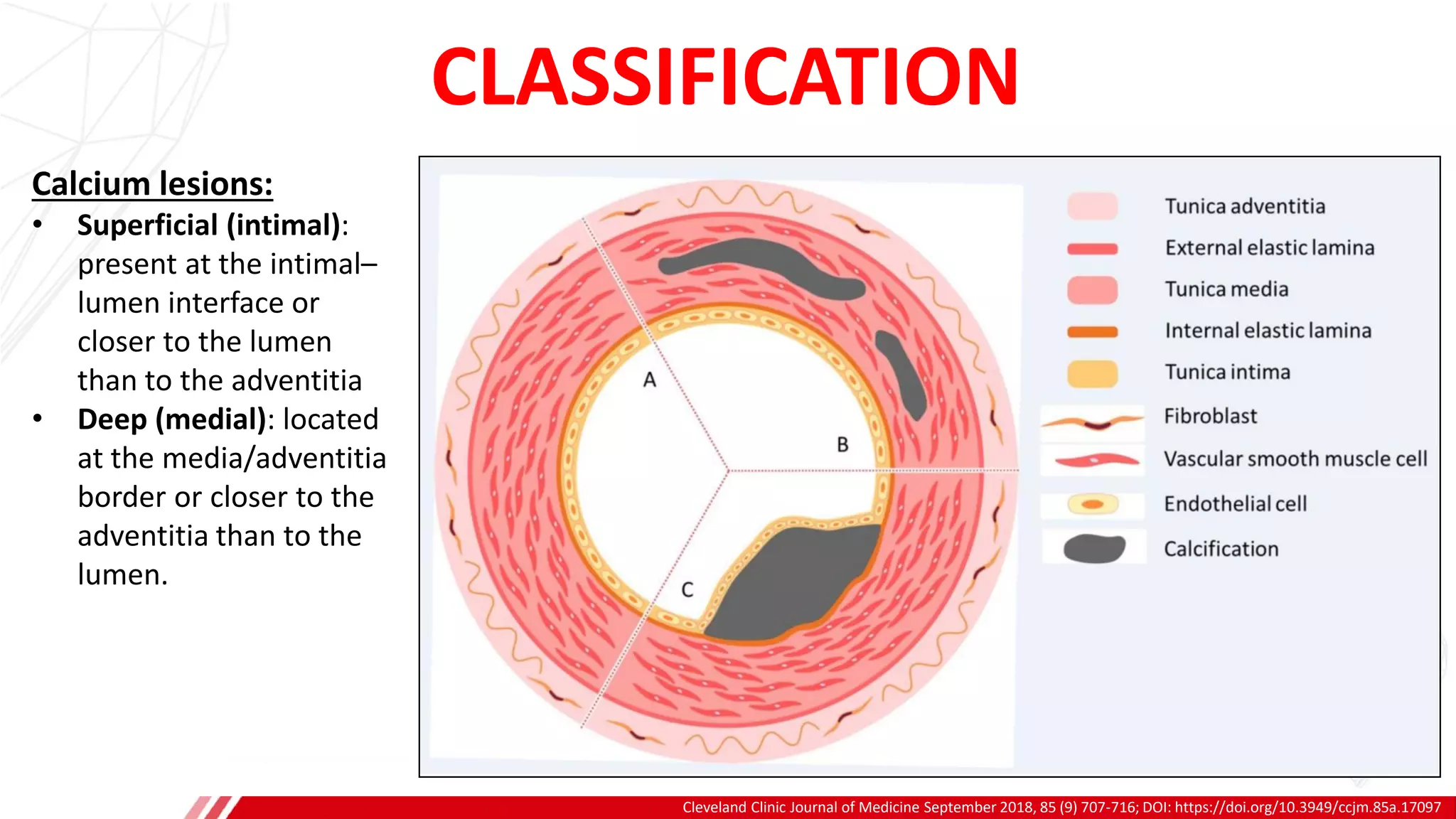 CALCIUM MODIFICATION TECHNIQUES IN COMPLEX PCI | PDF | Heart and ...