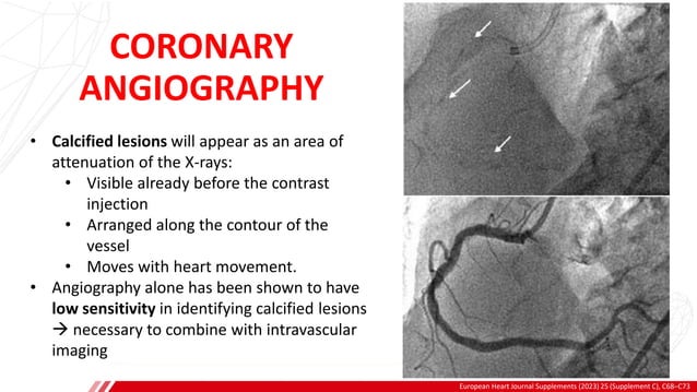 CALCIUM MODIFICATION TECHNIQUES IN COMPLEX PCI | PDF | Heart and ...
