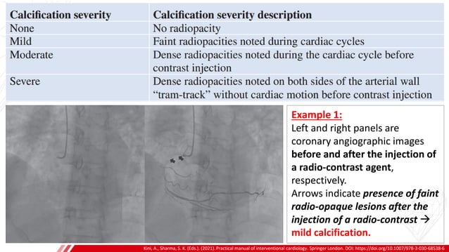 CALCIUM MODIFICATION TECHNIQUES IN COMPLEX PCI | PDF | Heart and ...