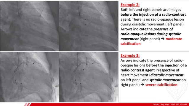 CALCIUM MODIFICATION TECHNIQUES IN COMPLEX PCI | PDF | Heart and ...