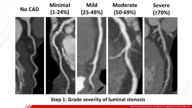 CALCIUM MODIFICATION TECHNIQUES IN COMPLEX PCI | PDF | Heart and ...